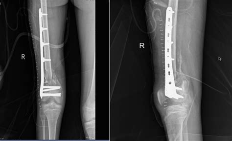 “shimming A Plate” Technique To Correct The Coronal Malalignment In