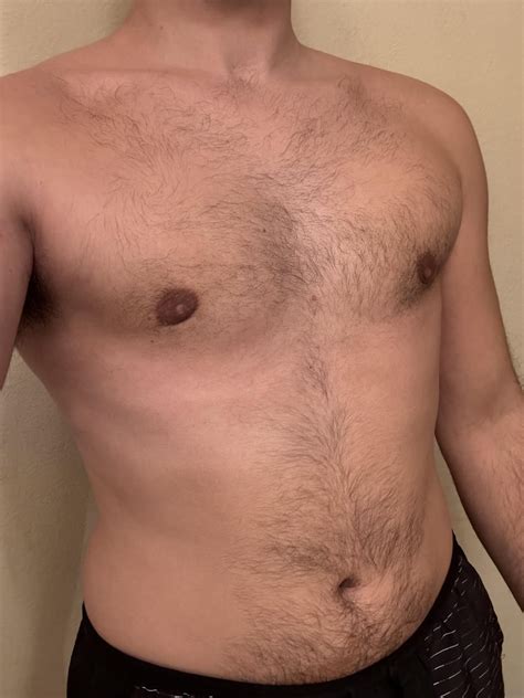 5 Weeks Post Op Still Looking Good Rgynecomastia