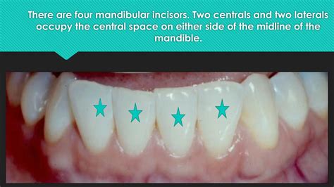 The Morphology Of Permanent Mandibular Incisors Ppt