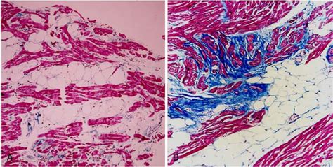 Arrhythmogenic Right Ventricular Cardiomyopathy Histology