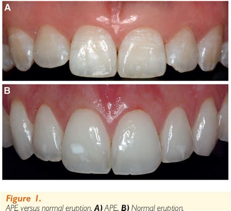 Figure 1 From Prevalence Of Altered Passive Eruption In Orthodontically
