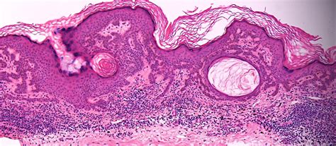 Seborrheic Keratosis Histology