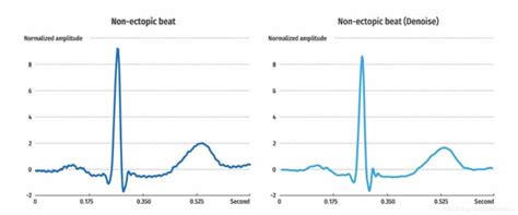 论文笔记：a Deep Convolutional Neural Network Model To Classify Heartbeats