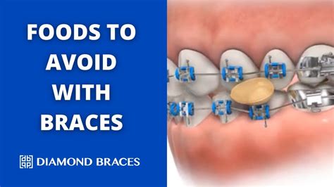 Braces Food Dos And Don Ts