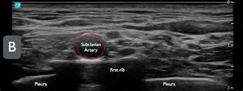 Supraclavicular Nerve Block