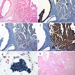 Workflow For The Retrospective Cohort 37 Cases Of PCL With Download Scientific Diagram