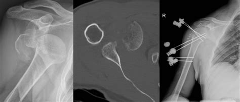 Virtual Library Shoulder Trauma Proximal Humerus Fracture