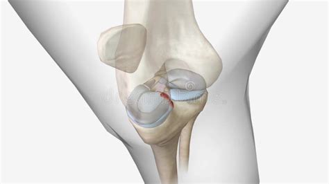 Meniscal Root Tears Are Less Common Than Meniscal Body Tears And Frequently Go Undetected Stock