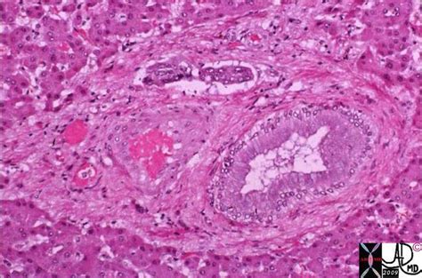 Liver Metastases Disease