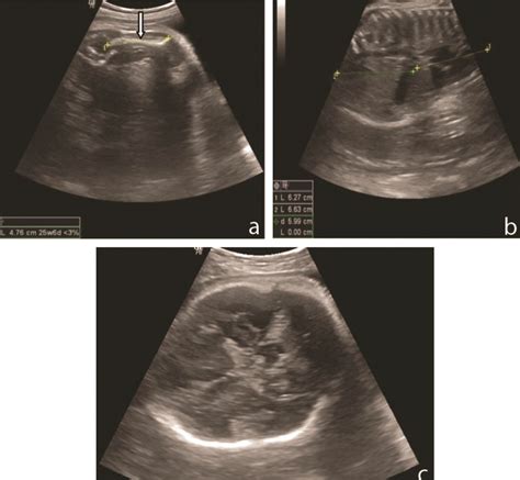 Macrocephaly Ultrasound