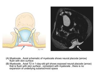 Congenital Diseases Of The Spine Ppt
