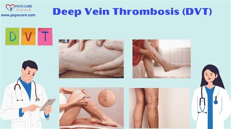 Deep Vein Thrombosis Dvt Causes Symptoms And Treatments Payo Care