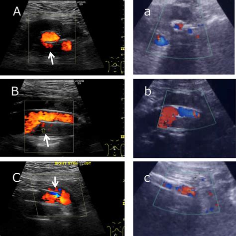 Postoperative 3d Ct An Afx Endograft Was Placed Into The Zenith Main