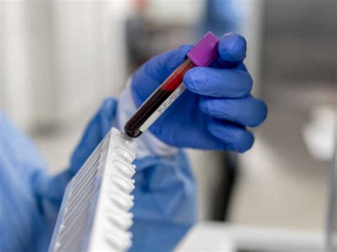 Hematology Analyzer Revolutionizing Medical Diagnostics