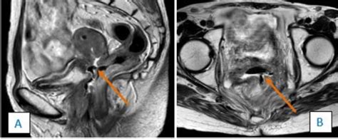 Pdf Iatrogenic Rectovaginal Fistula Repair By Trans Perineal Approach