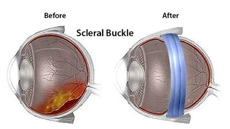 What Is A Scleral Buckle Retina Consultants Of Nevada Las Vegas
