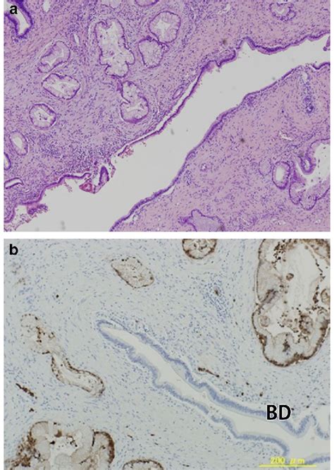 Histopathologic Findings Of Cholangiocarcinoma Of Periductal Spread