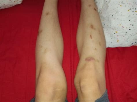 Random Bruised Spots On Legs Rdiagnoseme