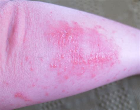 2013 Photos Of Poison Ivy Rashes Poison Ivy Cures Help And Information