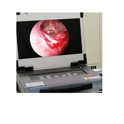 173 Inch Portable Endoscopy Camera System For Hysteroscopy