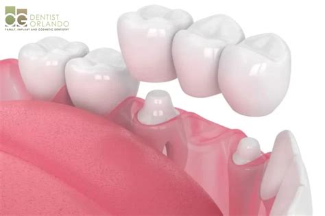 How Does A Dental Bridge Stay In Your Mouth Cg Dentist Orlando