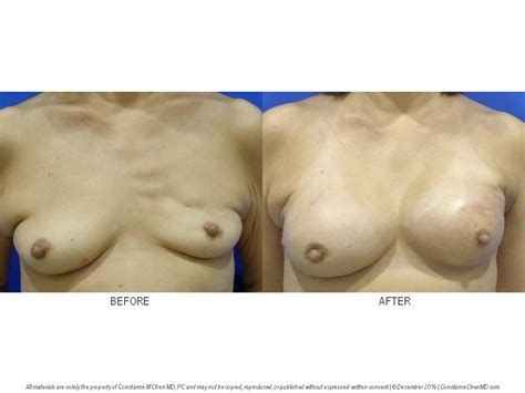 Implant Based Breast Reconstruction Constance M Chen Md