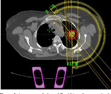 Figure 2 From Verification And Dosimetric Impact Of Acuros Xb Algorithm For Stereotactic Body
