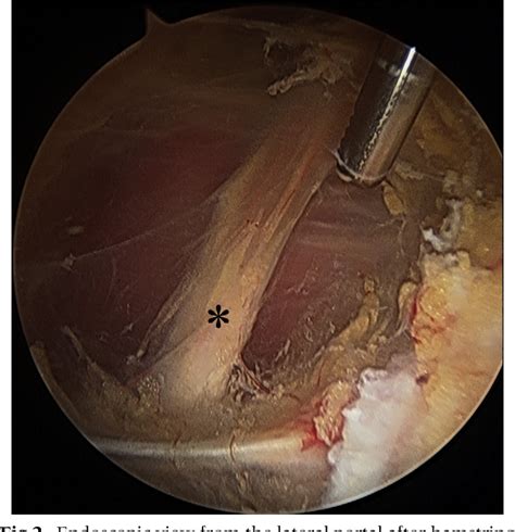 Figure 1 From Endoscopic Repair Of Proximal Hamstring Avulsion Semantic Scholar