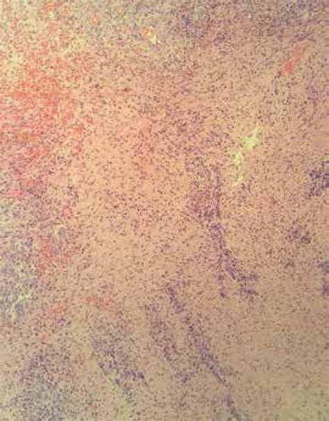 Scielo Brasil Exuberant Pyoderma Gangrenosum In A Patient With