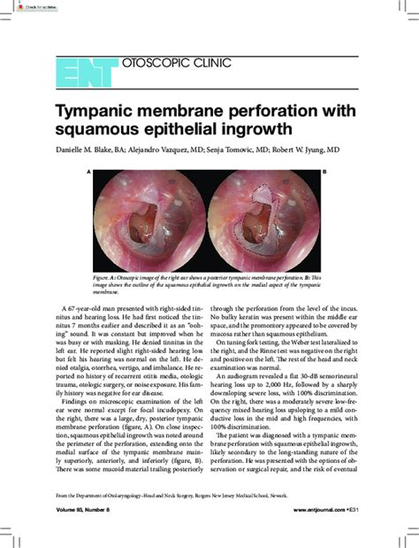 Pdf Tympanic Membrane Perforation With Squamous Epithelial Ingrowth