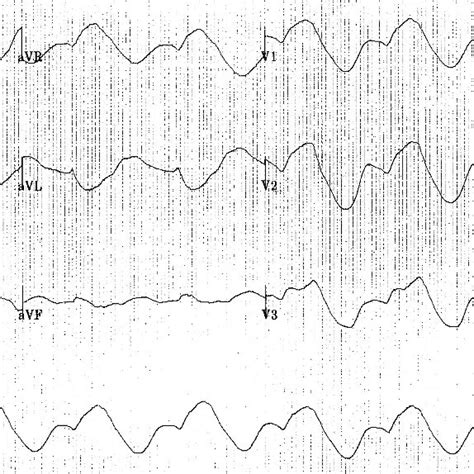 Pdf Identification Of Sine Wave In Early Suspicion Of Hyperkalemia