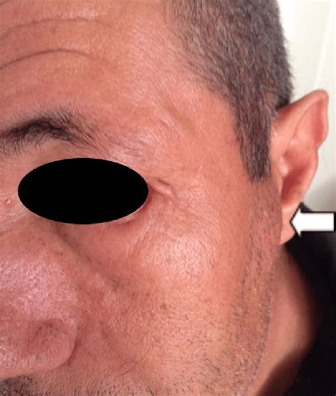 Enlarged Lymph Node Of The Left Tragus Area Arrow Download