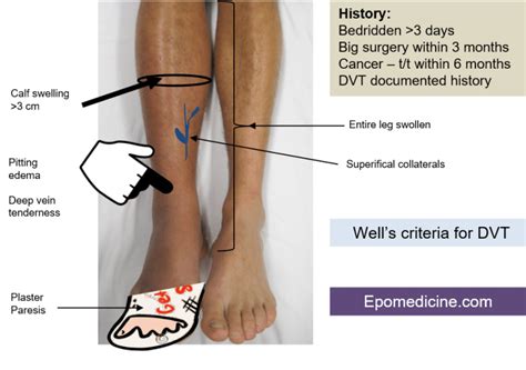 Wells Criteria For Dvt With Mnemonic Epomedicine