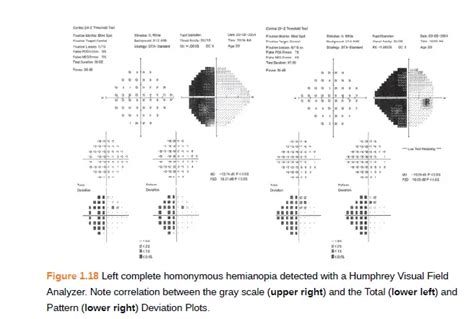 Five Step Approach To Visual Field Interpretation An Eye Care Blog