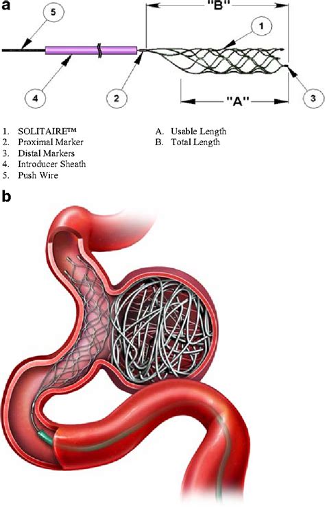 Coil Embolization Root Operation At Kristie Cummings Blog