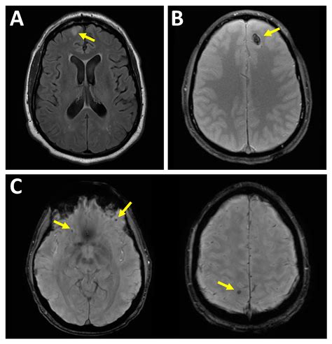 Brain Contusion Understanding Causes Symptoms And Treatment