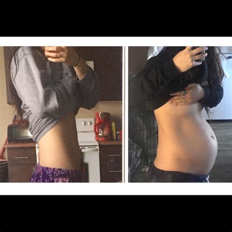 Me Normally Vs 1 Day After An Ovarian Cyst Burst Causing Internal