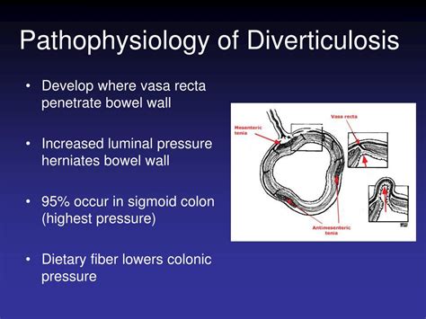 Vasa Recta Diverticulosis 91 Diverticulosis Radiology Key