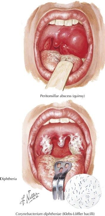 Sintomas De Difteria Em Adultos Síntomas Y Complicaciones De La