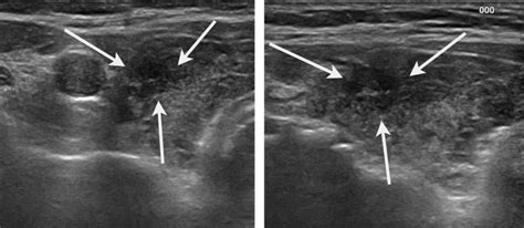 Heterogeneous Echogenicity Of The Underlying Thyroid Parenchyma How