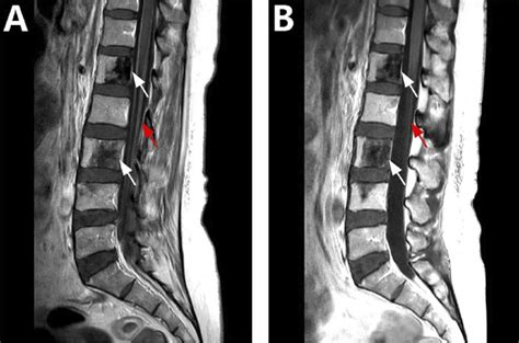 Sagittal T1 Weighted T1w Spinal Mri Notes A Baseline Mri Showed