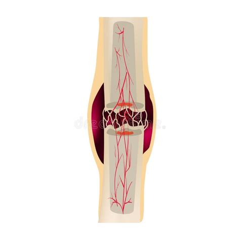 2 Stage Of Healing Bone Fracture Formation Of Callus The Bone