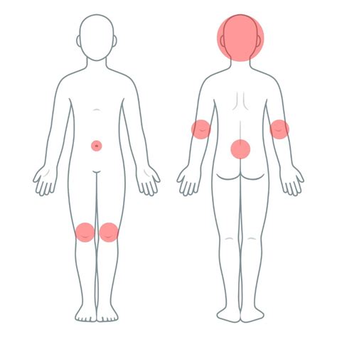 5 Types Of Psoriasis — Noted Dermatology