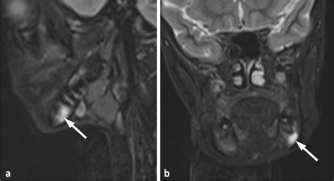 Sagittal Stir Spinal Image Set A From Wb Mri Is Used To Verify A