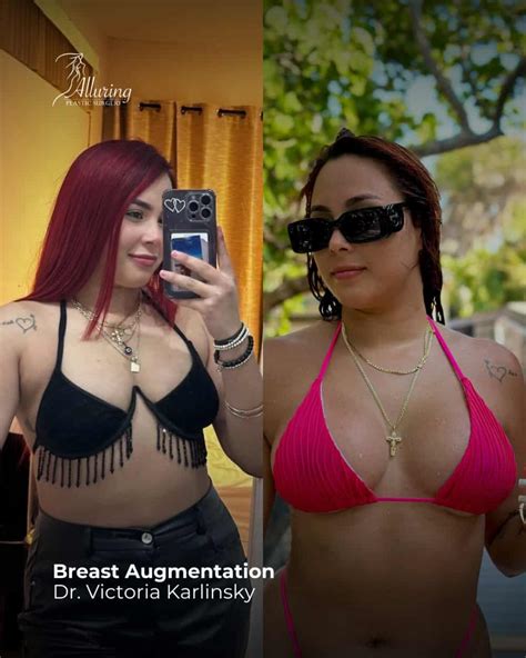 Breast Augmentation Gallery Before And After Photos Miami Alluring