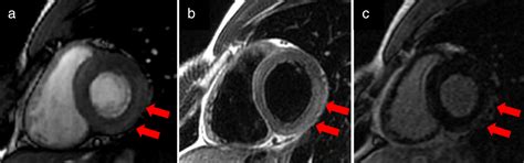 Myocarditis Mri Image Mri Of Patient With Myocarditis And Pericardial
