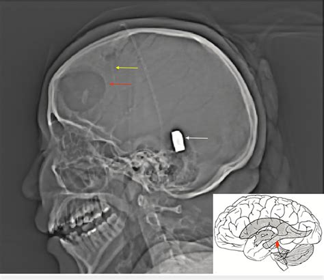 Ct Head Scout Image Demonstrates The Migration Of The Bullet White Download Scientific Diagram