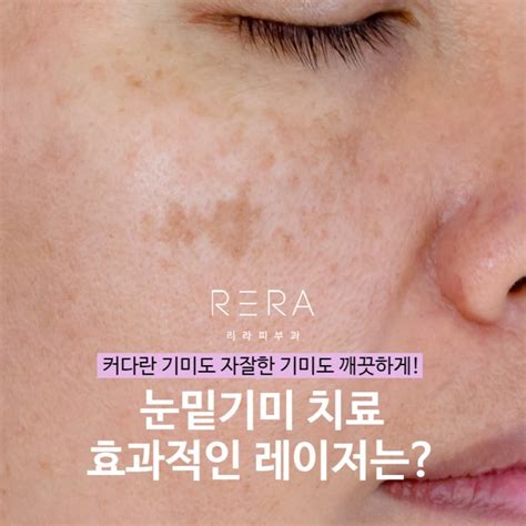 삼성동피부과커다란 눈밑기미 제거를 위한 레이저 종류와 치료방법 네이버 블로그