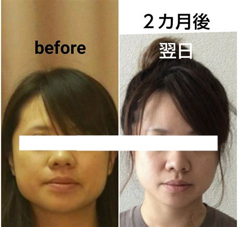 驚きの変化！小顔矯正before～after集 奈良大和高田 小顔矯正と美肌 で若々しく変化！まごころエステmatoria