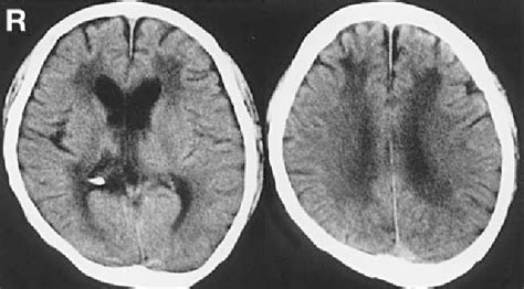 Figure 1 From Transcortical Transchoroidal Fissure Approach For